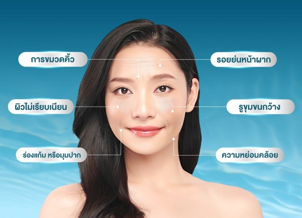 RADIESSE PROGRAM - Amis Aesthetics