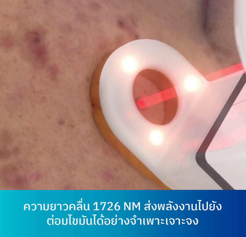 AviClear Laser Program - Amis Aesthetics